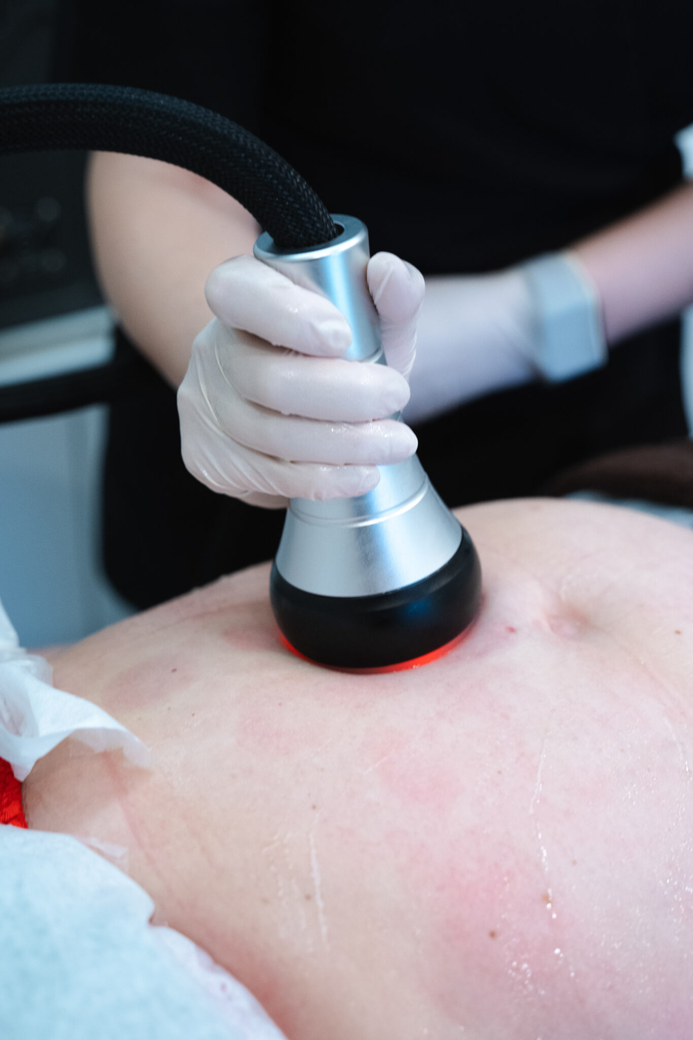 Lipokavitacija ir vakuuminė procedūra kūnui - Grožio stotelė